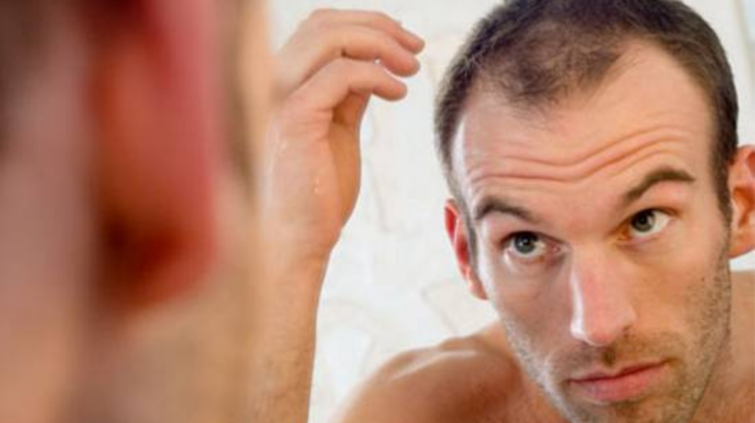 Todo lo que necesitas conocer sobre la calvicie - IHC